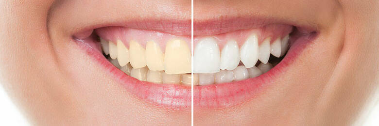 How effective are teeth whiteners? - Consumer NZ